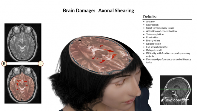 DK Global | Case Feature | $925K Settlement From $10K Offer Using TBI ...