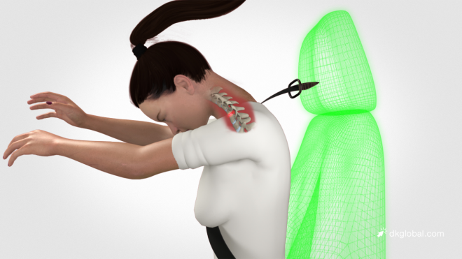 DK Global | Case Feature | Settlement for Nurse’s Cervical Spine ...