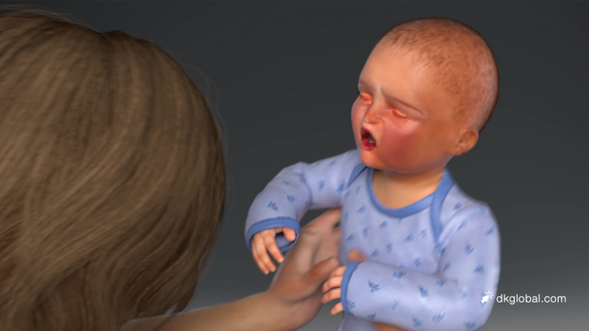 DK Global | Case Feature | Parental Abuse Causes Fractures and TBI in ...