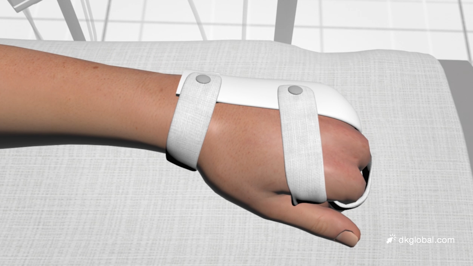 DK Global | Case Feature | $735K Settlement for Shattered Hand in ...