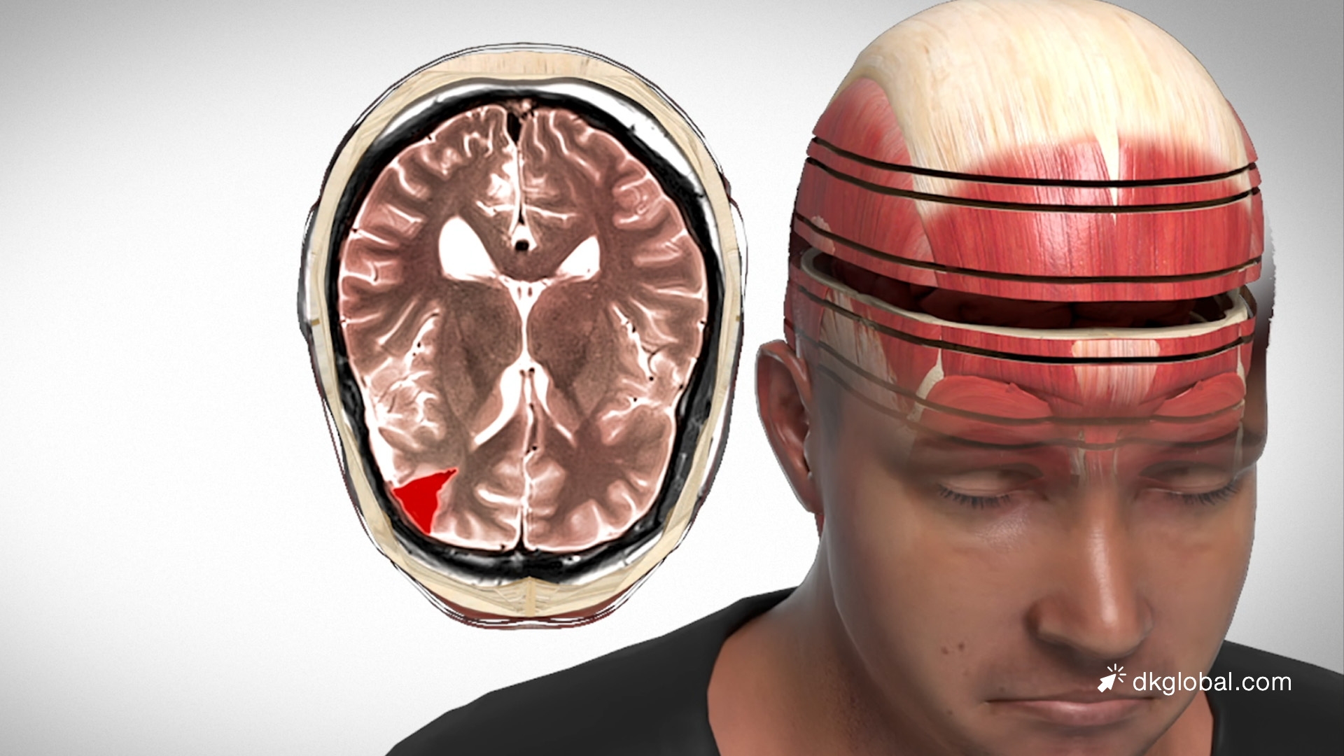 DK Global | Case Feature | TBI Victim’s CT Scans Prove Progressive Brain Damage