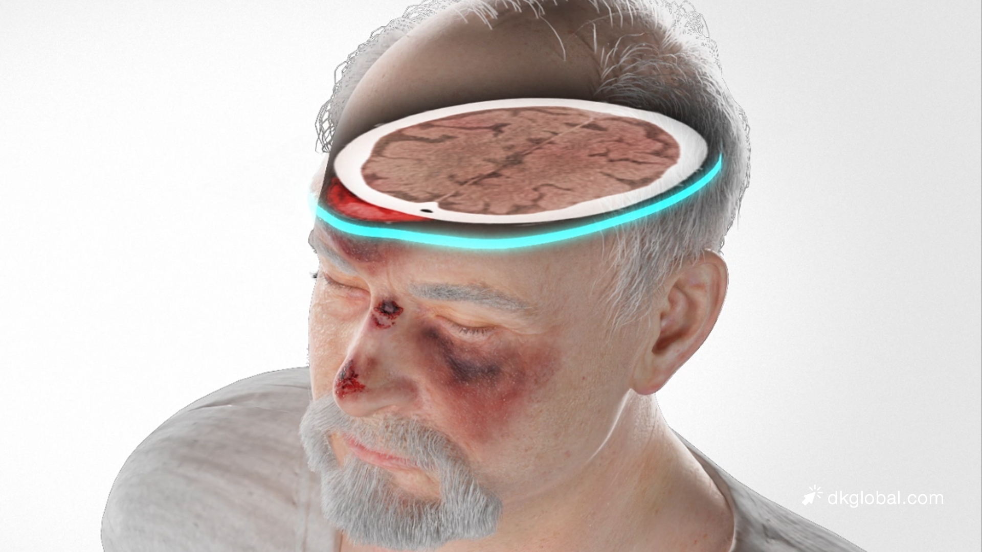 DK Global | Case Feature | $100K Offer Before Trial Turned Into $4.8M ...