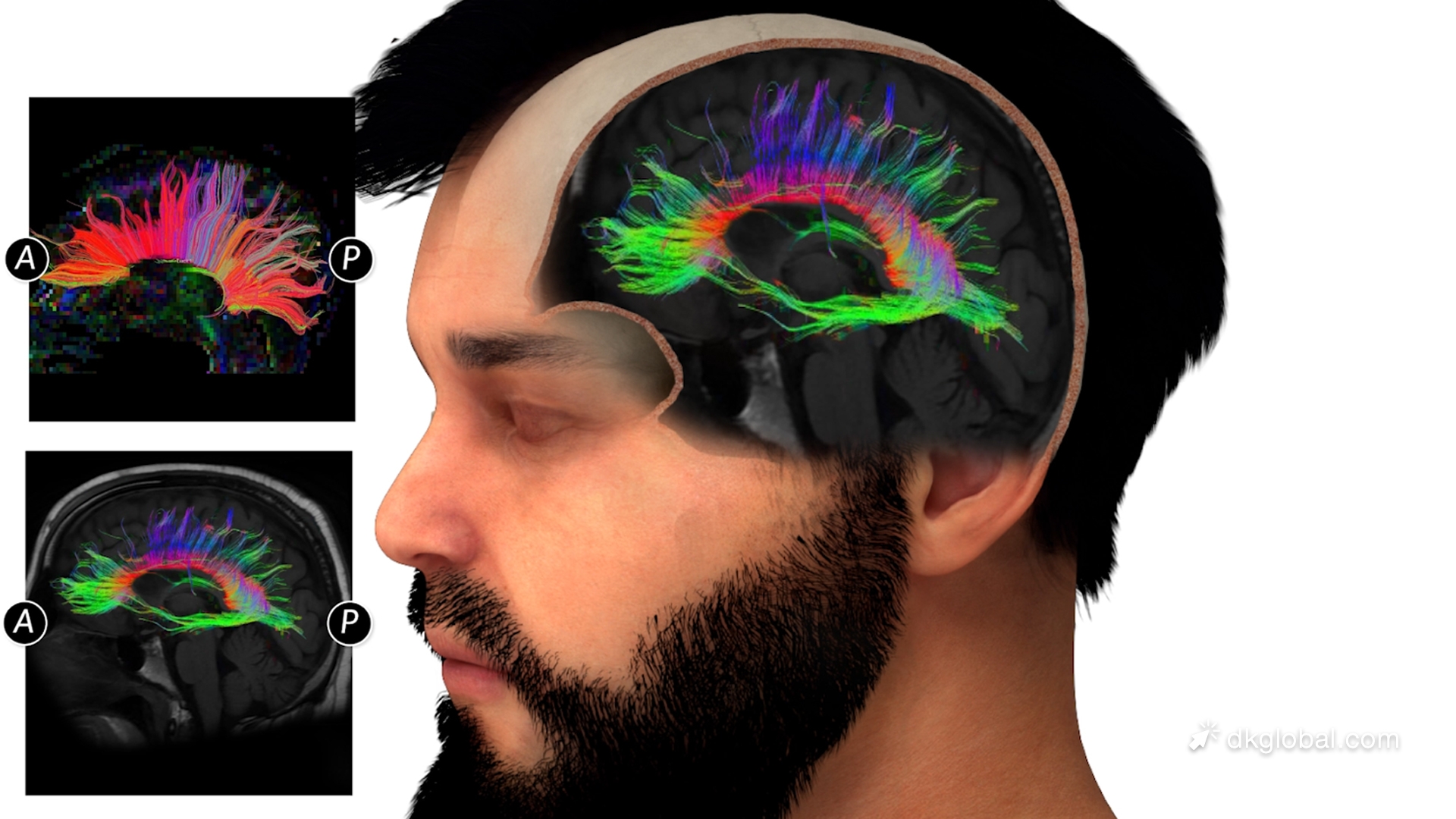 DK Global | Case Feature | $3M Judgment for TBI by Using Advanced ...