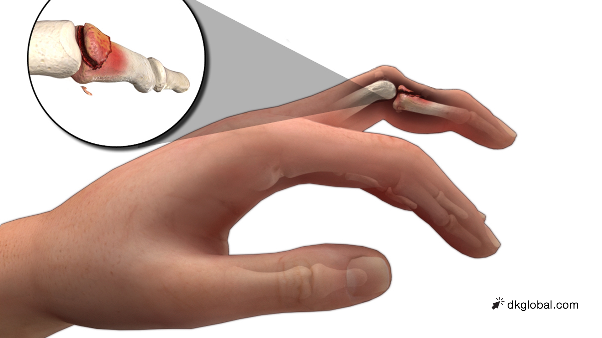 DK Global | Case Feature | Six-Figure Verdict for Assault Victim after ...