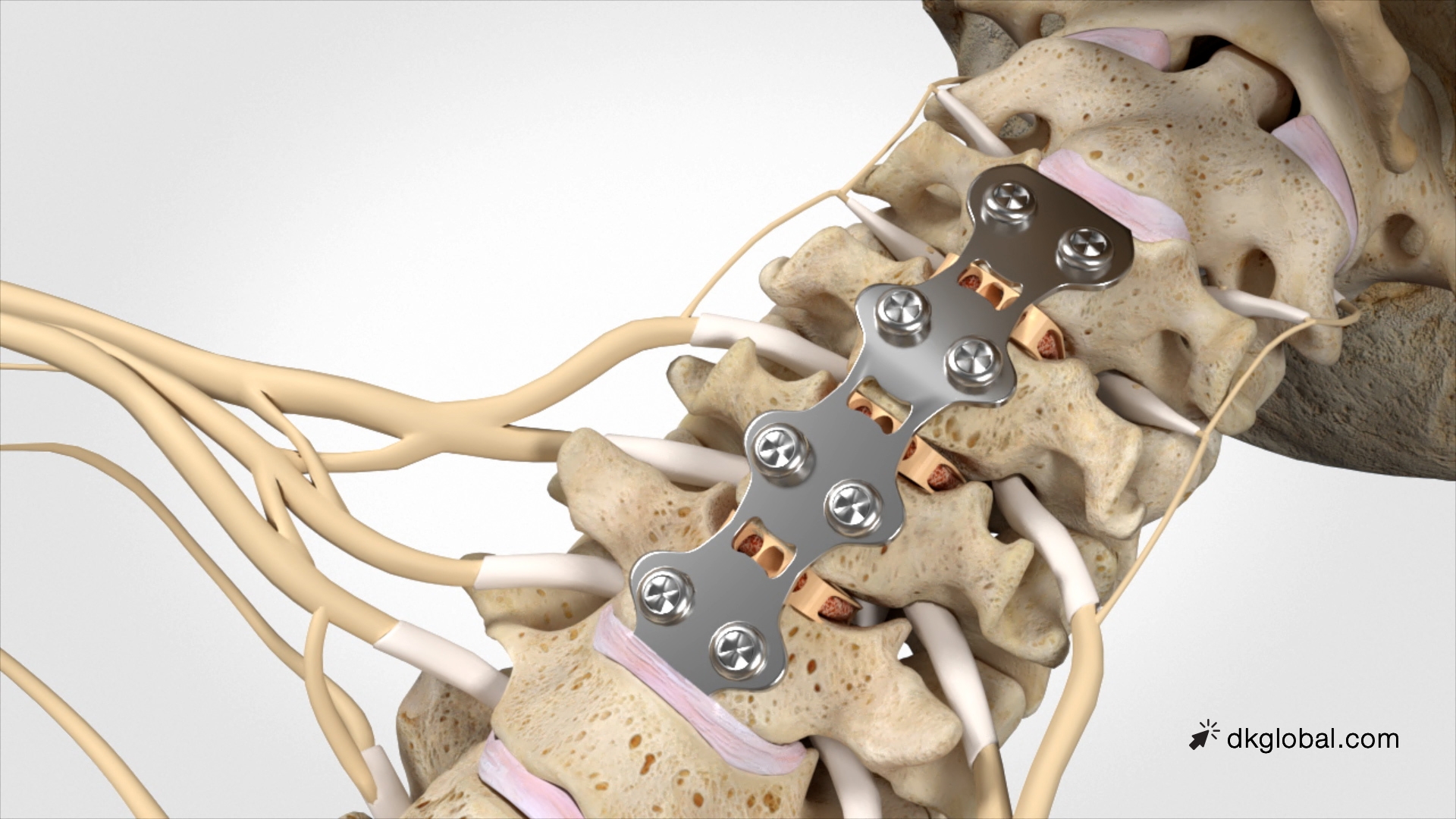 DK Global | Case Feature | Worker Suffers Severe Spinal Injuries After ...