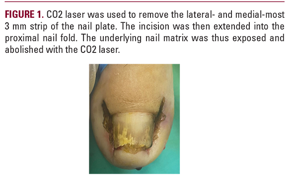 CO2 Laser Matricectomy for the Treatment of Pincer Nail Deformity: A ...