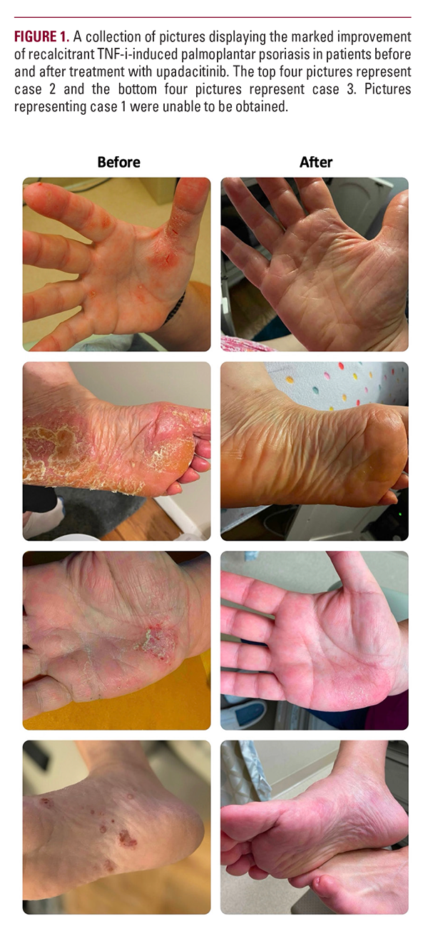 A Case Series of TNF Inhibitor-Induced Psoriasis Successfully Treated ...