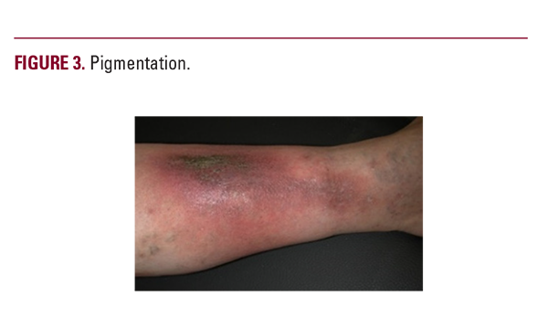 Improvement of Chronic Venous Insufficiency Related Leg Xerosis and ...