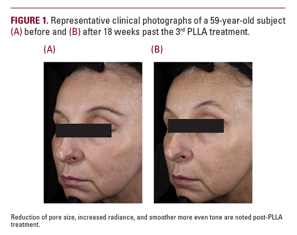 A Clinical Histology Study Evaluating the Biostimulatory Activity ...