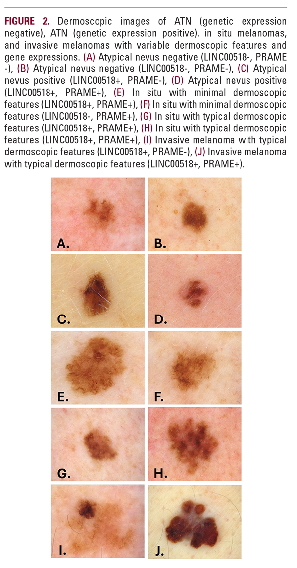 Genomic Analysis Aids in the Management of Dermoscopically Atypical ...