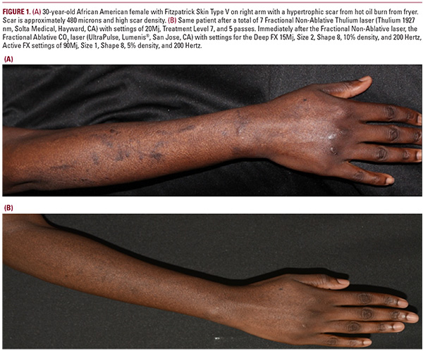 The Diagnostic Role of Optical Coherence Tomography (OCT) in Measuring ...