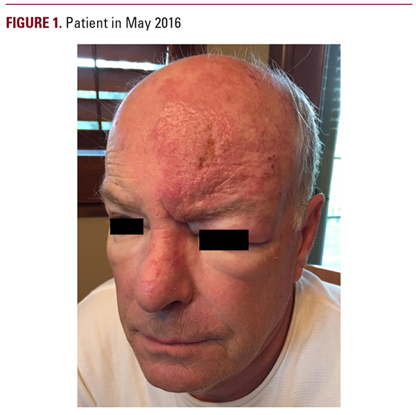 Temporal Association of Herpes Zoster Eruption Post-Aminolevulinic Acid ...