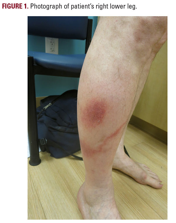 Serpiginous Purpuric Eruption of the Leg - JDDonline - Journal of Drugs ...