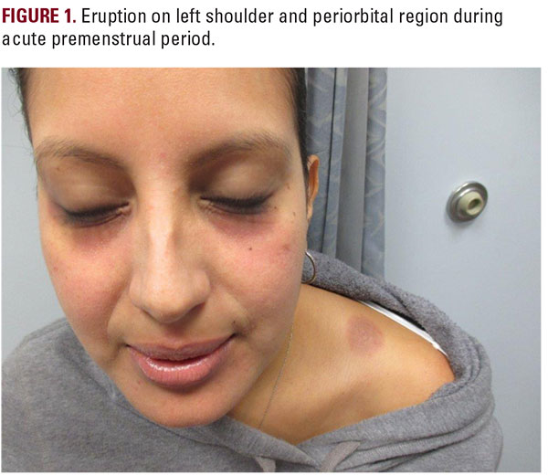 Autoimmune Progesterone Dermatitis: A Diagnosis to Consider in a ...