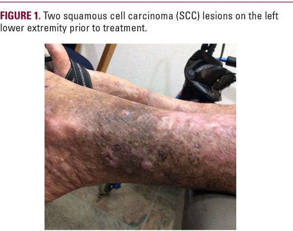 Squamous Cell Carcinoma On Leg