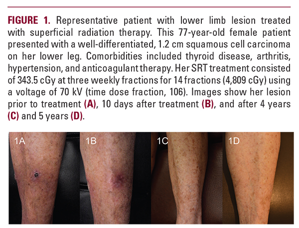 Superficial Radiation Therapy: A Viable Nonsurgical Option for Treating ...