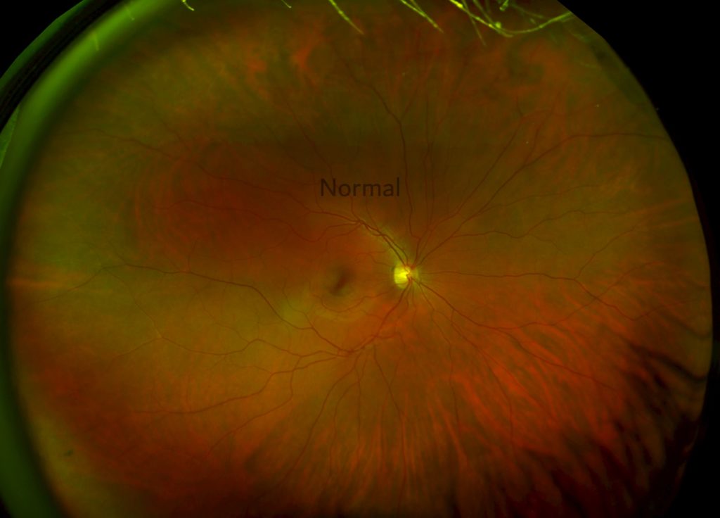 Diabetic Eye/Retinal Imaging