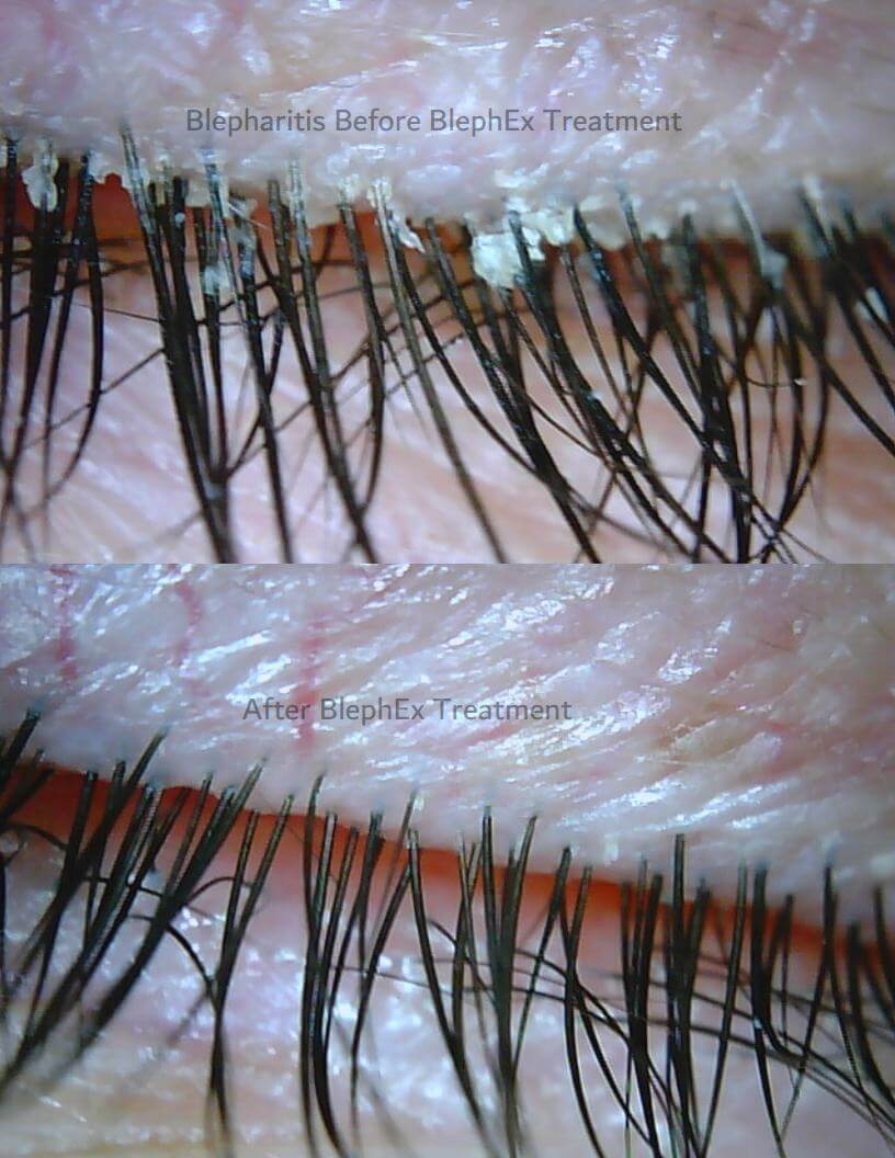 BlephEx® & Blepharitis - BC | Your Local Optometrist