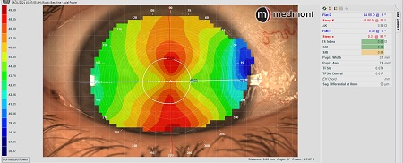 New Multifocal GP Lenses Improve Vision for 63-Year-Old