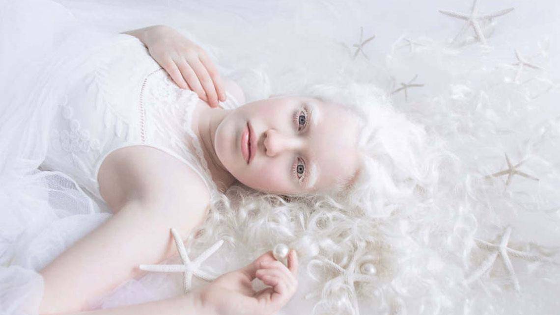 Poor Eyesight From Albinism? Our Optometrists Are Here to Help!