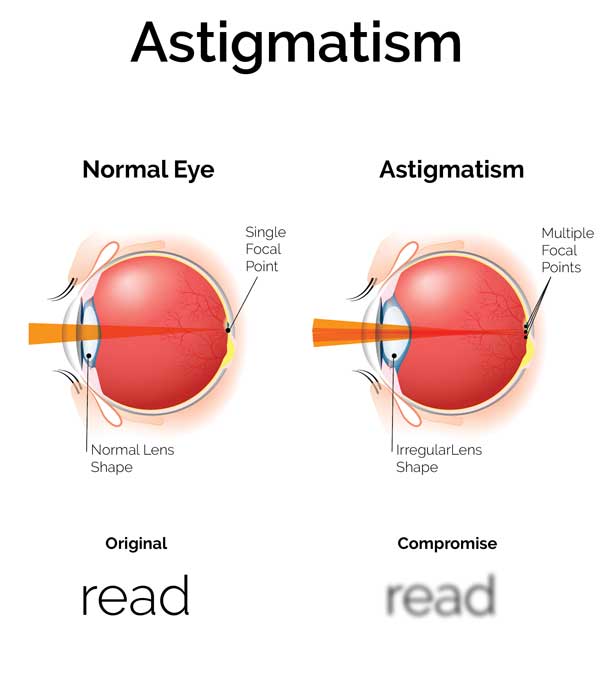What Is Astigmatism 
