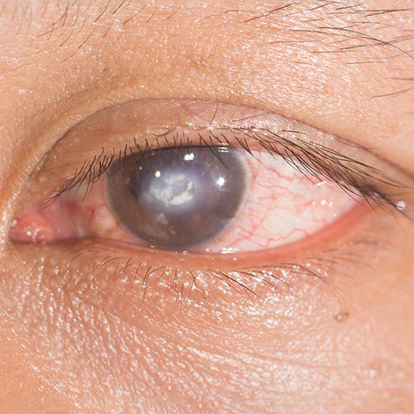 PRK Eye Surgery Washington, DC - Maryland - Virginia - Andrew E ...