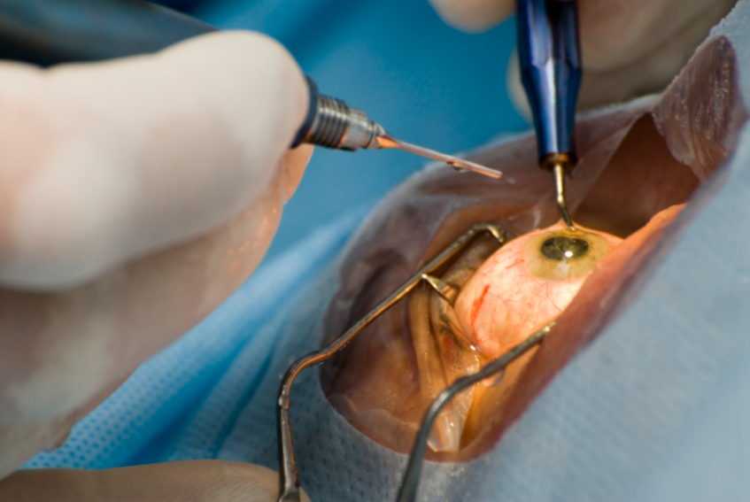 Privilegiert Treffen Sektion Laser Lens Surgery Flug Schnell Untergeordnet Privilegiert Treffen Sektion Laser Lens Surgery Flug Schnell Untergeordnet