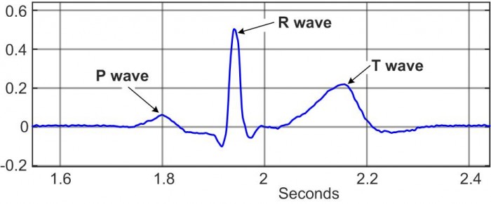 60-Hz Noise and Baseline Drift Reduction in ECG Signal Processing ...