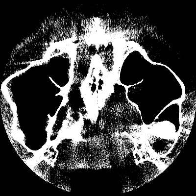 CT Bone- maxilla and mandible - Dental, Orthodontic, Maxillofacial CTs ...