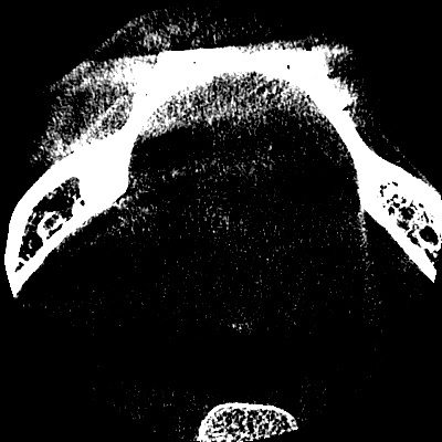 CT maxilla bone - Dental, Orthodontic, Maxillofacial CTs - embodi3D.com