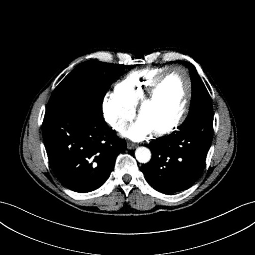 Compilation of Chest CT Scans - Thorax CTs - embodi3D.com