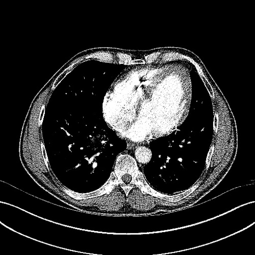 Compilation of Chest CT Scans - Thorax CTs - embodi3D.com
