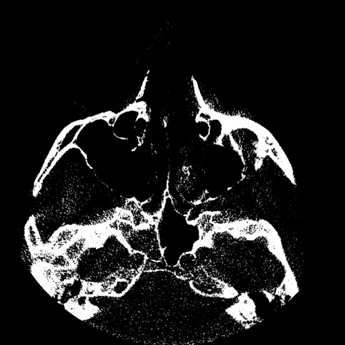 GSW to the face - Skull, Head, and Neck CTs - embodi3D.com