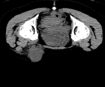Left Groin Leiomyosarcoma CT Scan - Lower Extremity CTs - embodi3D.com
