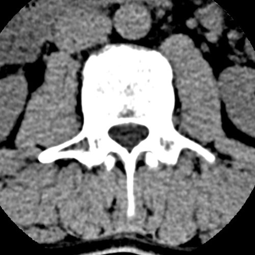 l2-l3-ct - Spine CTs - embodi3D.com