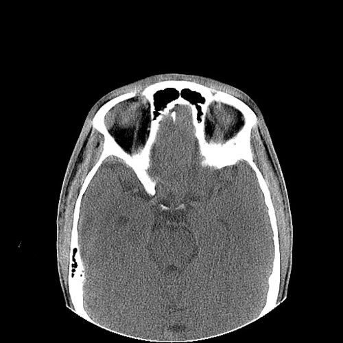 Orbital region CT scan - Skull, Head, and Neck CTs - embodi3D.com