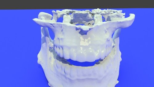 Teeth Model - stl file processed - Dental, Orthodontic, Maxillofacial ...