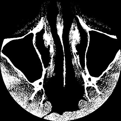 CT maxilar - Dental, Orthodontic, Maxillofacial CTs - embodi3D.com
