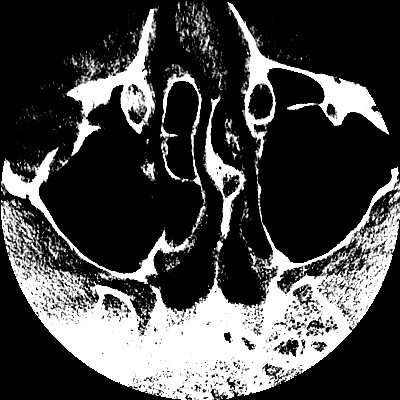 CT maxilar - Dental, Orthodontic, Maxillofacial CTs - embodi3D.com
