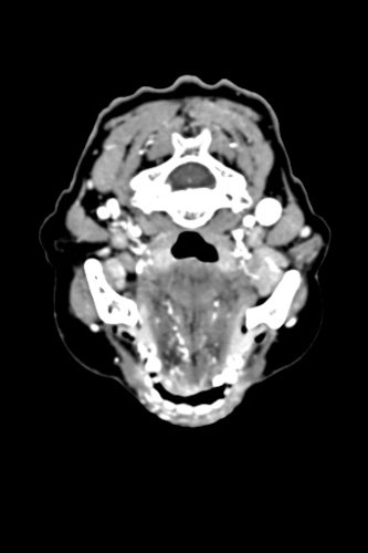 CTA head for video tutorial - Skull, Head, and Neck CTs - embodi3D.com