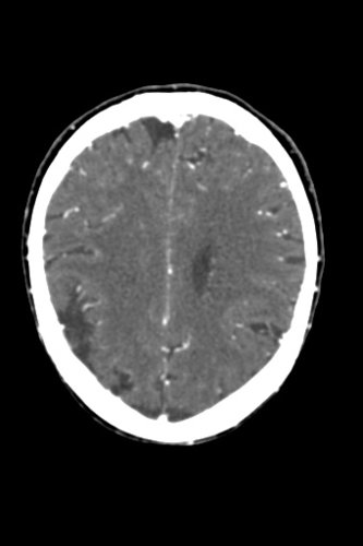 CTA head for video tutorial - Skull, Head, and Neck CTs - embodi3D.com