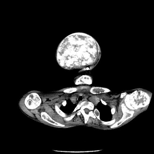 Ossifying Fibroma - Skull, Head, and Neck CTs - embodi3D.com
