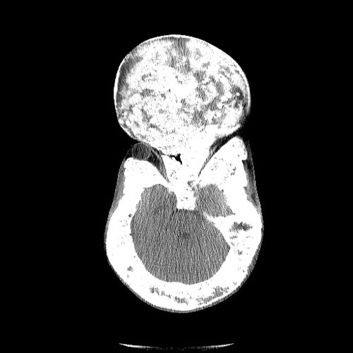 Ossifying Fibroma - Skull, Head, and Neck CTs - embodi3D.com