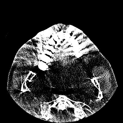 test maxilla cyst bone - Dental, Orthodontic, Maxillofacial CTs ...