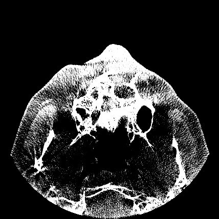 test maxilla cyst bone - Dental, Orthodontic, Maxillofacial CTs ...