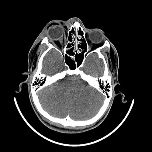 dicom - Skull, Head, and Neck CTs - embodi3D.com