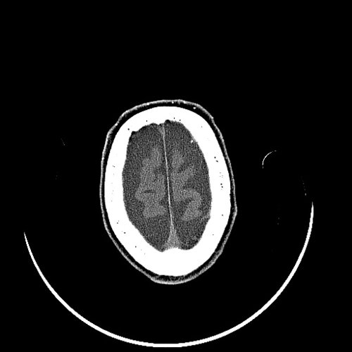 Skull CT Scan - Skull, Head, and Neck CTs - embodi3D.com