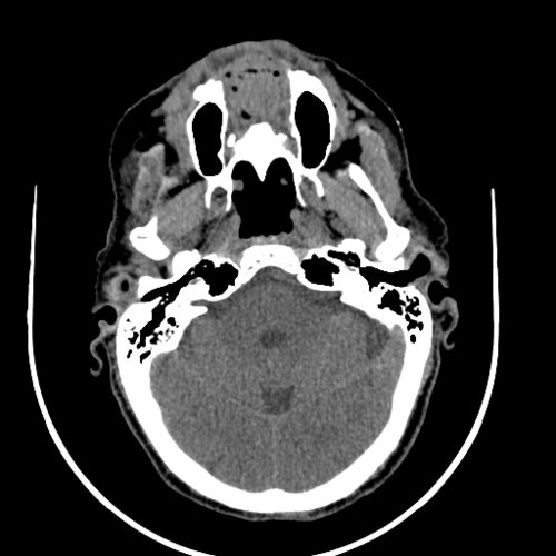 Thin Skull CT - Skull, Head, and Neck CTs - embodi3D.com