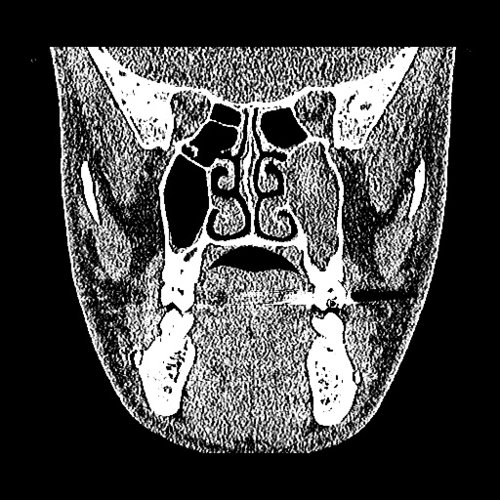 CT Head Twisted Maxilla - Dental, Orthodontic, Maxillofacial CTs ...