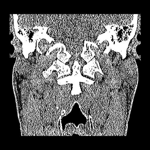 CT Head Twisted Maxilla - Dental, Orthodontic, Maxillofacial CTs ...